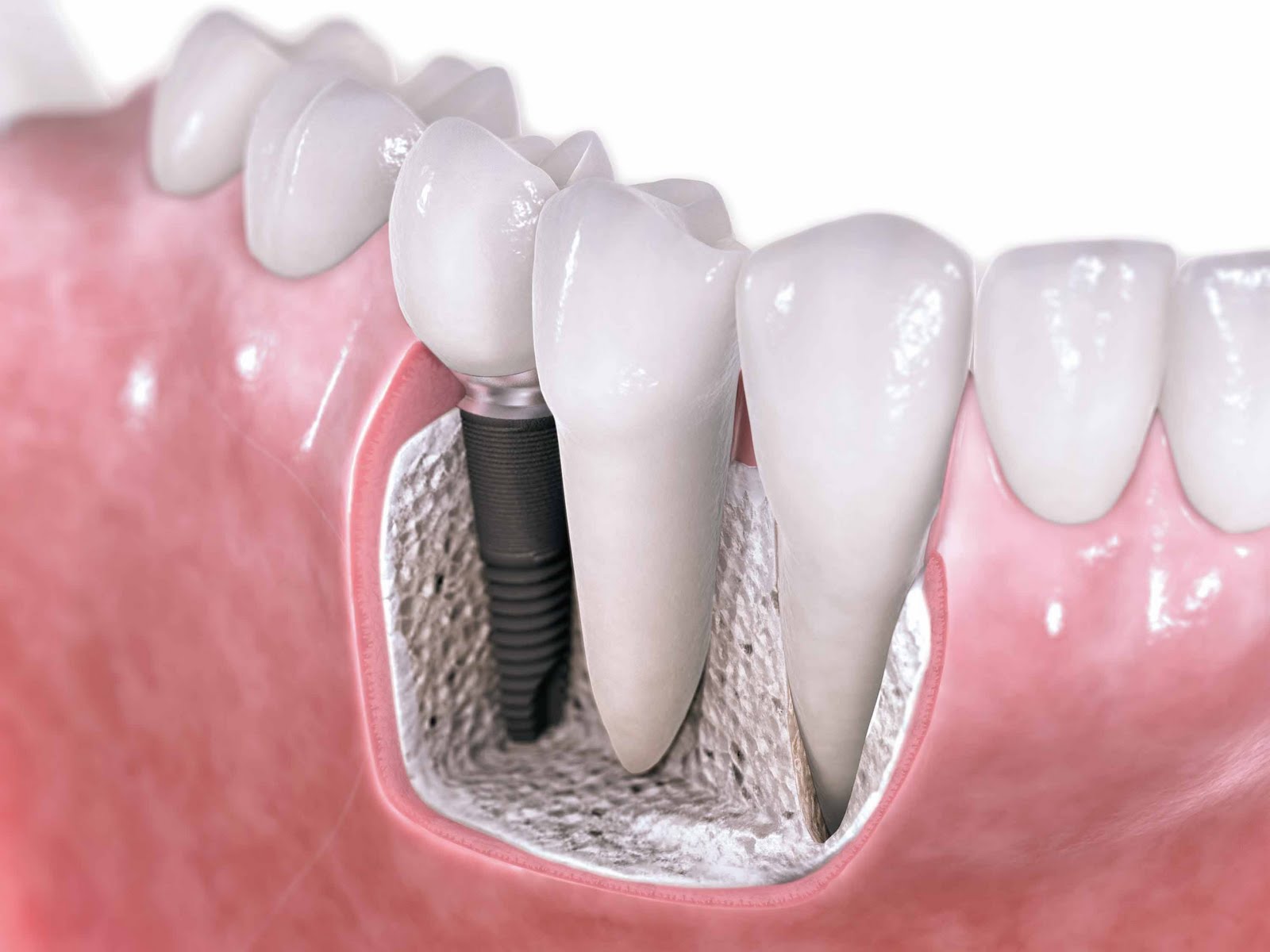 In-depth Guide to Treatment: Dental Implants | ArticleCube