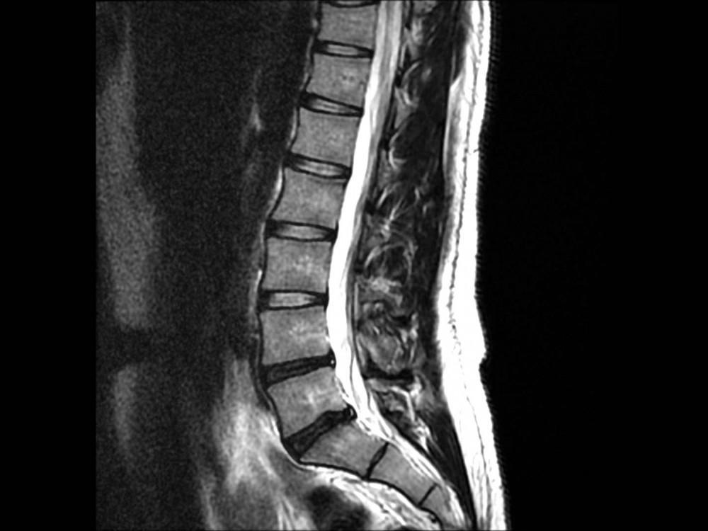 5 Debunked Myths About Spine MRI | ArticleCube
