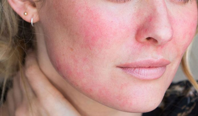 7 Common Reasons for Red Face That May Surprise You | ArticleCube