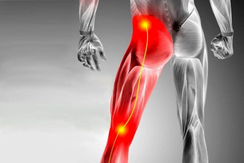 7 Myths About Sciatica You Shouldn't Believe | ArticleCube
