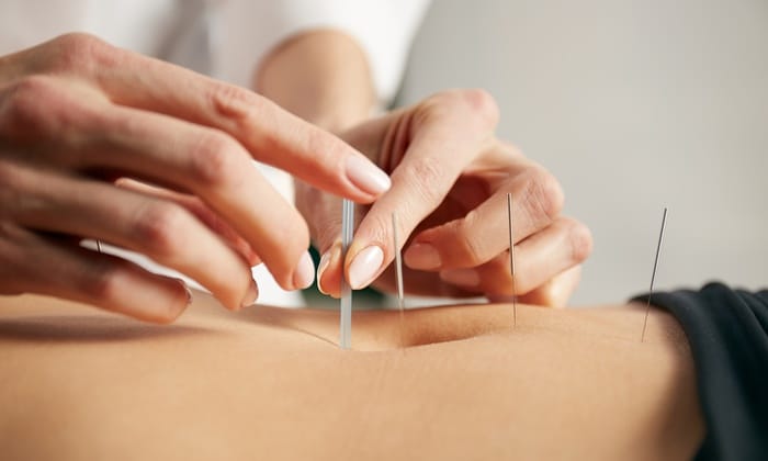 7 Awesome Health Benefits of Acupuncture That Will Surprise You ...