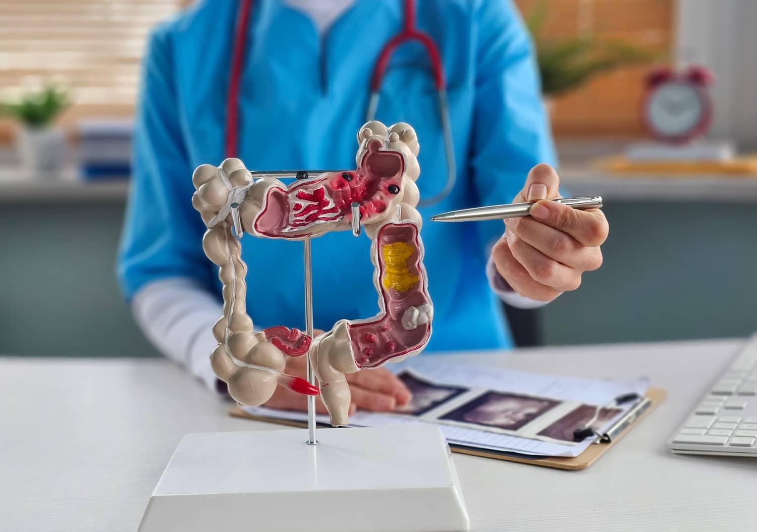 How to Prevent Colorectal Cancer With Regular Screenings and Early ...